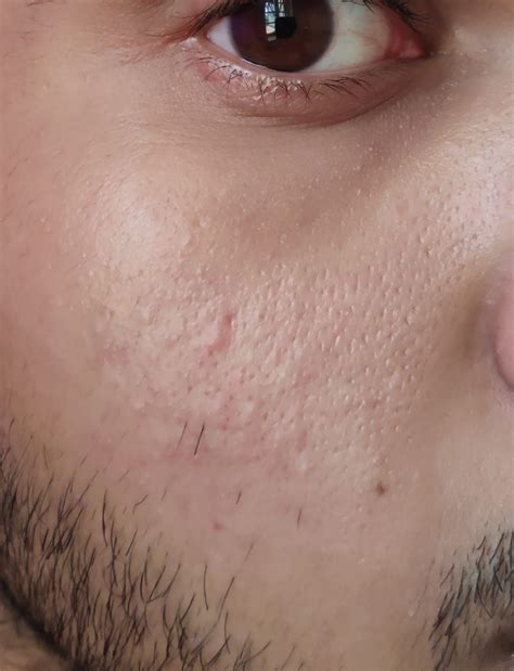 Bumpy Texture On Face