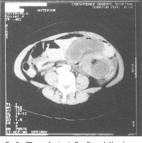 Figure 2 From Intussusception After Roux En Y Gastric Bypass Semantic Scholar