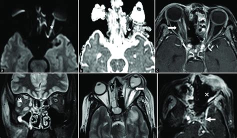 A And B Dwi A And Adc Map B Diffusion Restriction In Left Optic Download Scientific