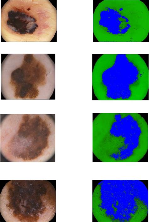 Figure 5 4 From Computer Aided Diagnosis System For Melanoma Lesion Detection Semantic Scholar
