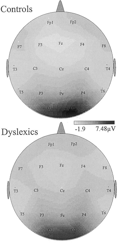 Figure 1 From Neurophysiology Attenuated Hemispheric Lateralization In Dyslexia Evidence Of A