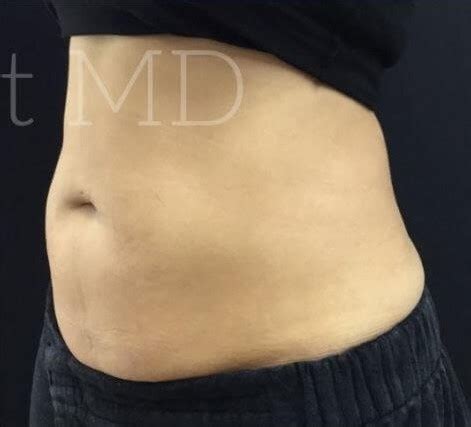 Abdomen Sculpt Md