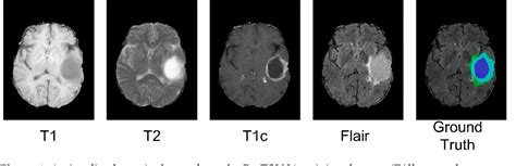Figure 1 From Axial Attention Convolutional Neural Network For Brain Tumor Segmentation With