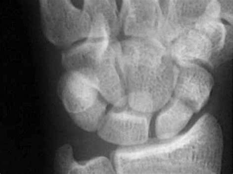 Displaced Fracture Of The Waist Of The Scaphoid Bone And Joint