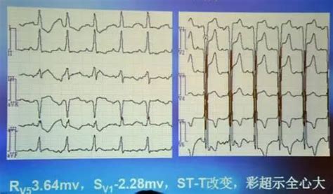 非心肌缺血st T改變？ 5min學透心電圖系列 壹讀