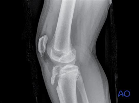 Highlights Of Pediatric Proximal Tibia