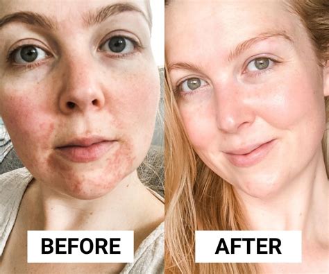Mild Perioral Dermatitis