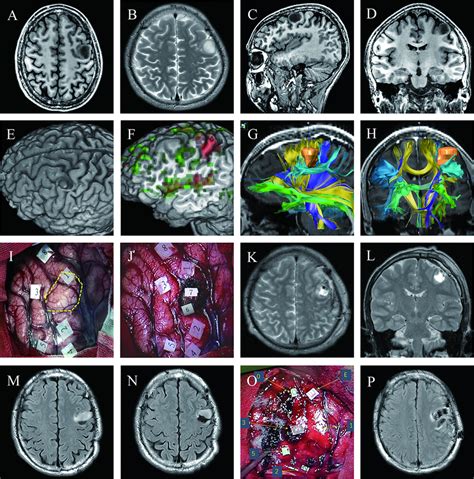 Maximum Safe Resection Of Astrocytoma With Idh Mutation Who Grade 2 Download Scientific