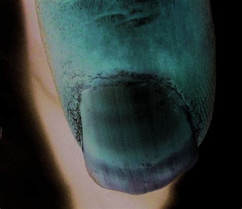 Evaluation Of Nail Abnormalities And Their Implications Flashcards