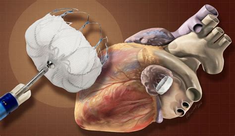 Device For Irregular Heartbeat May Be More Cost Effective Than