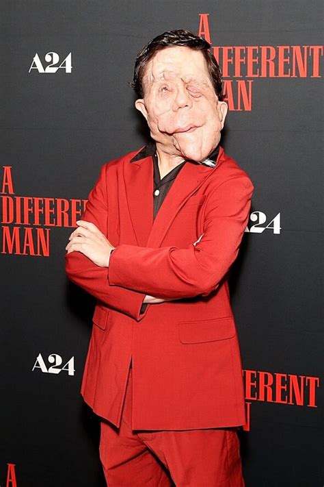 What Condition Does Adam Pearson Have And How Did It Progress