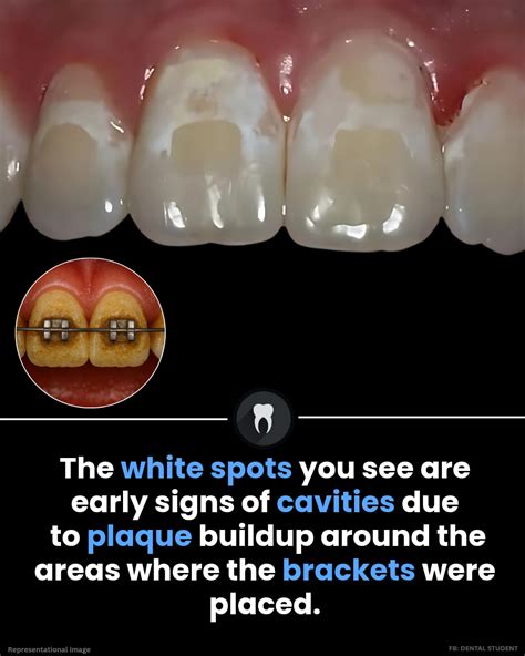 Braces Care 101 How To Avoid White Spots And Cavities Dentist Approved