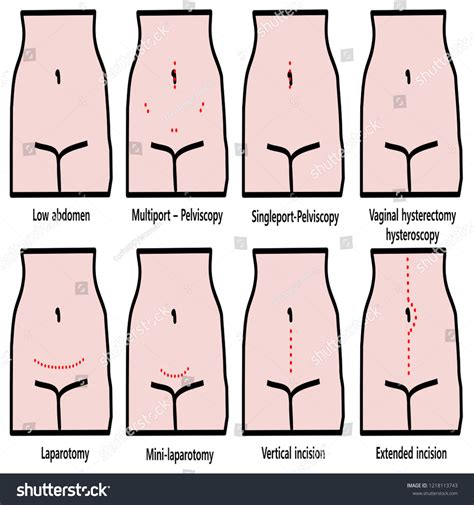 Gynecological Incision Laparotomy Laparoscopy Stock Illustration