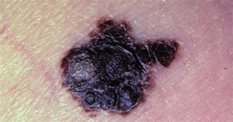 Stage 4 Melanoma Staging Mucosal Melanoma Symptoms Staging And