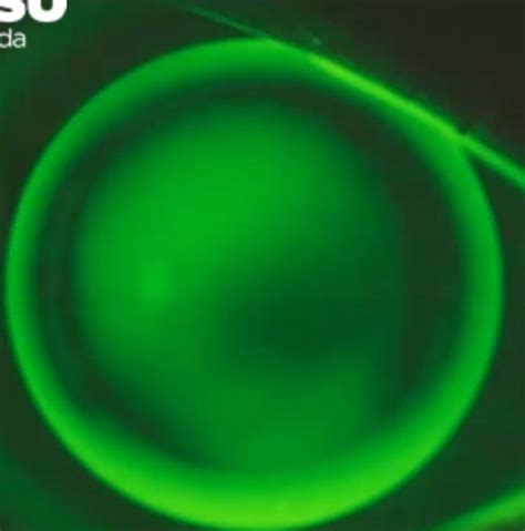 Cl Ii Gp Ectasia Part 2 Flashcards Quizlet