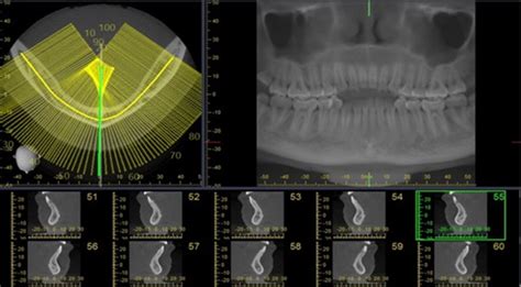 The Mandibular Incisive Canal Visibility And Location On Cone Beam Computed Tomography Images