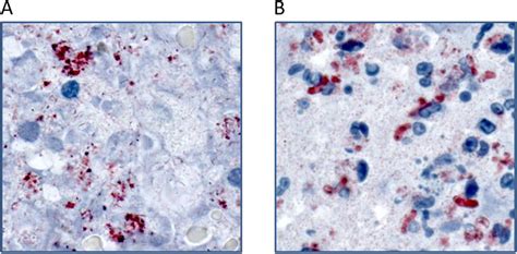 Ihc Staining Of Abundant Granular And Bacilliform Antigens In Skin