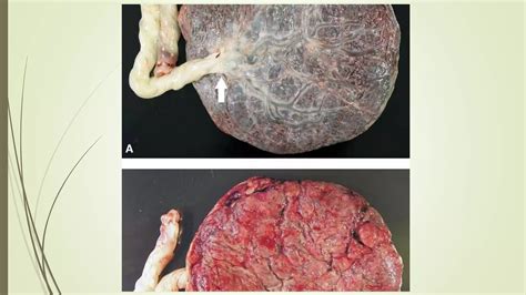 Placenta Anatomy Physiologypptx