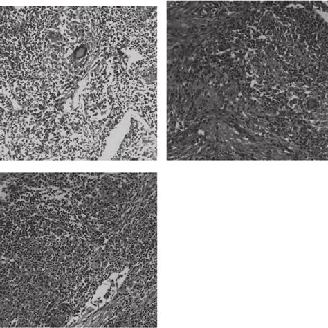 A Histopathology Of The Resected Lung Only The Sequestrated Lung