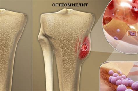 Остеомиелит Хабитус ООД Медико техническа лаборатория за ортези и протези в гр Варна