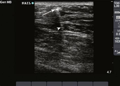 Foreign Body Removal Clinical Tree
