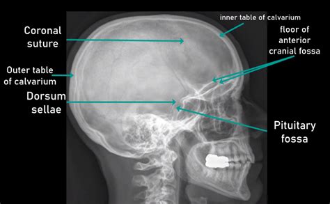 Lateral Skull X Ray Guide Radiologists Handbook Hsin Film