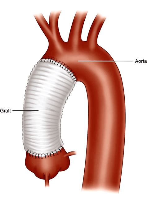 Протезиране на възходяща аорта Д р Андрей Андреев Кардиохирург