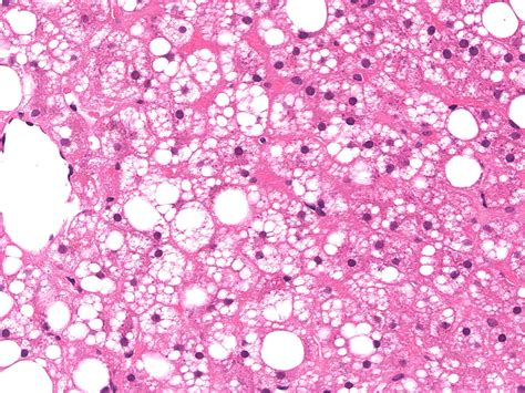 Pathology Outlines Nonalcoholic Steatohepatitis Nash