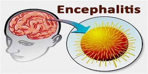 Encephalitis Definition