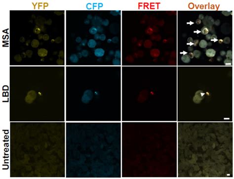 Intracellular Inclusions Induced By Patient Derived And Amplified α Synuclein Aggregates Are