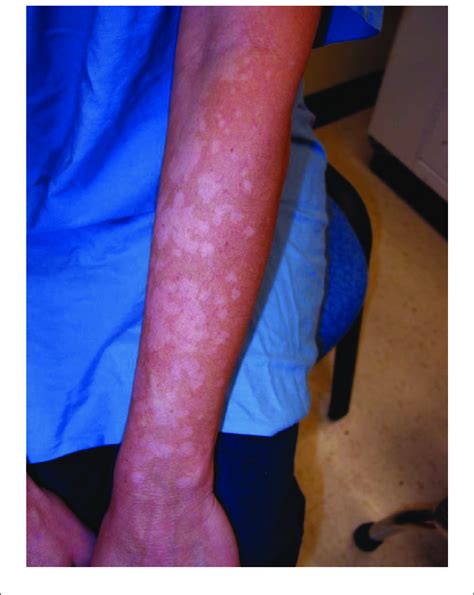 Multiple Hypopigmented Macules And Patches On The Left Forearm Download Scientific Diagram