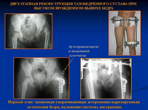 Врождённый вывих бедра презентация онлайн