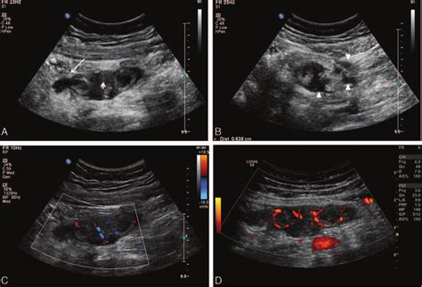 Abdominal Anatomy Ultrasound