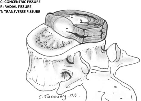 What Is An Annular Fissure Everything You Need To Know