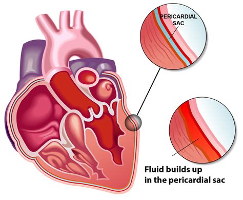 Pericardial Sac