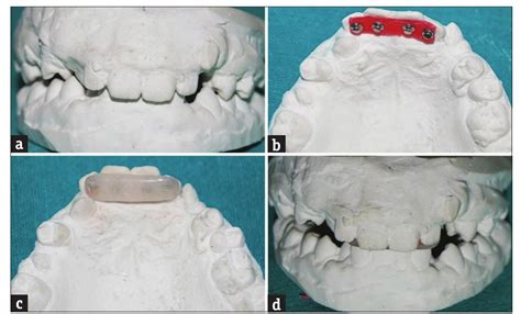 A Maxillary And Mandibular Cast In Occlusion Demonstrating