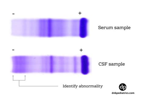 Csf Electrophoresis Interpretation Osce Station
