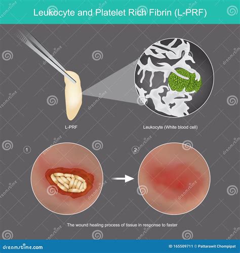 Fibrin Cartoons Illustrations And Vector Stock Images 334 Pictures To Download From