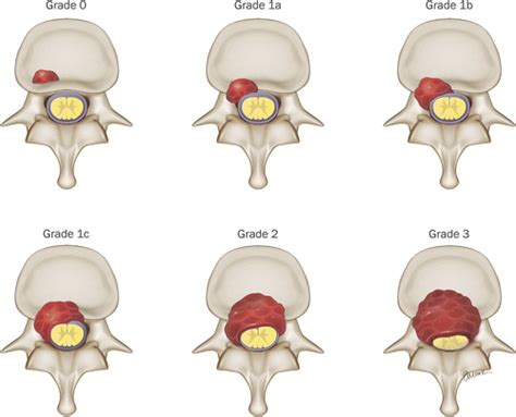 Fundamentals Of Radiation Oncology For Treatment Of Vertebral