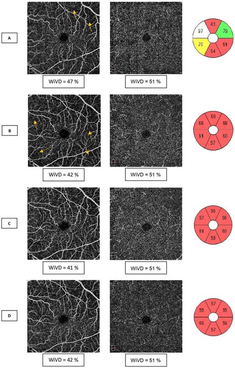 Same Patient As Figure 3 Macular OCT A Images Of The Superficial Download Scientific Diagram