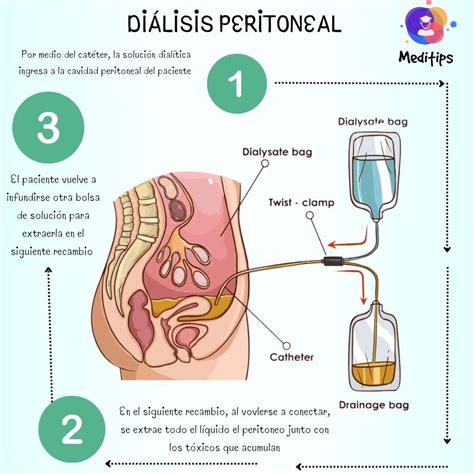¿qué Es La Diálisis Peritoneal Meditips