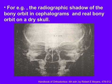 Errors In Cephalometry Pptx Dental Health Diseases And Conditions