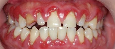 Consequences Of Neglecting Dental Treatment