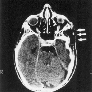Ct Scan Of Our One Patient With Minimal Expansion Of The Middle Cranial