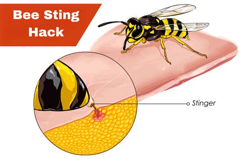 First Aid Management For A Bee Sting At Kaitlyn Corkill Blog