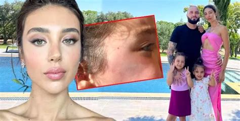 Berkay Şahin Kizi Yaralandi Haberler