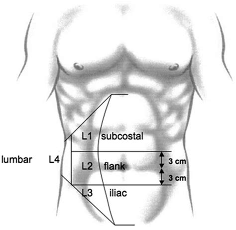 European Hernia Society Classification Of Lateral Incisional Hernias Download Scientific