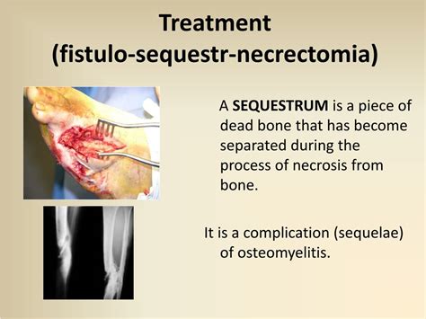 Ppt Open Compound Fractures Powerpoint Presentation Free Download