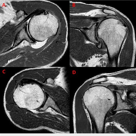 Bilateral Shoulder Mri Showing Irreparable Rotator Cuff Tear On Axial