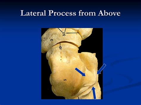 Lateral Process Of Talus Diagram Lateral Process Talus Fract